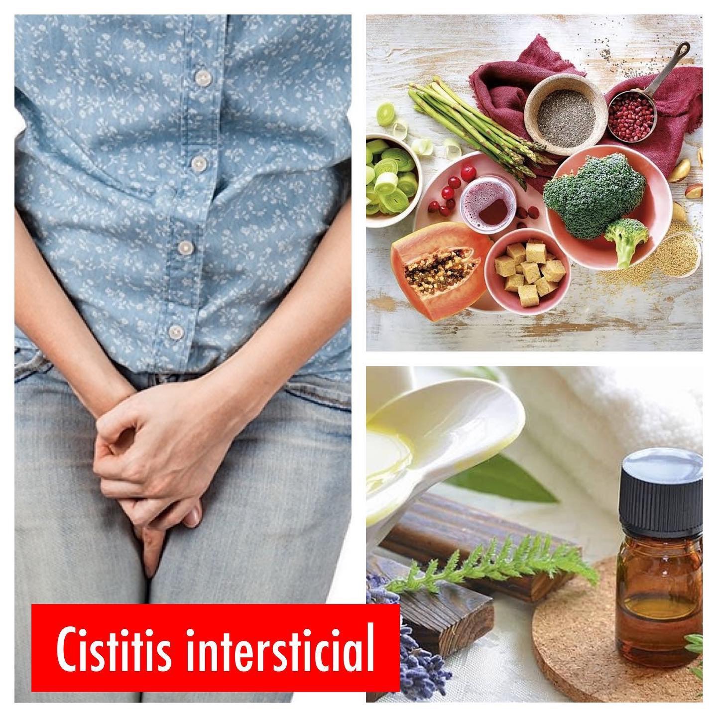 La comida puede aumentar los síntomas en la cistitis intersticial ...