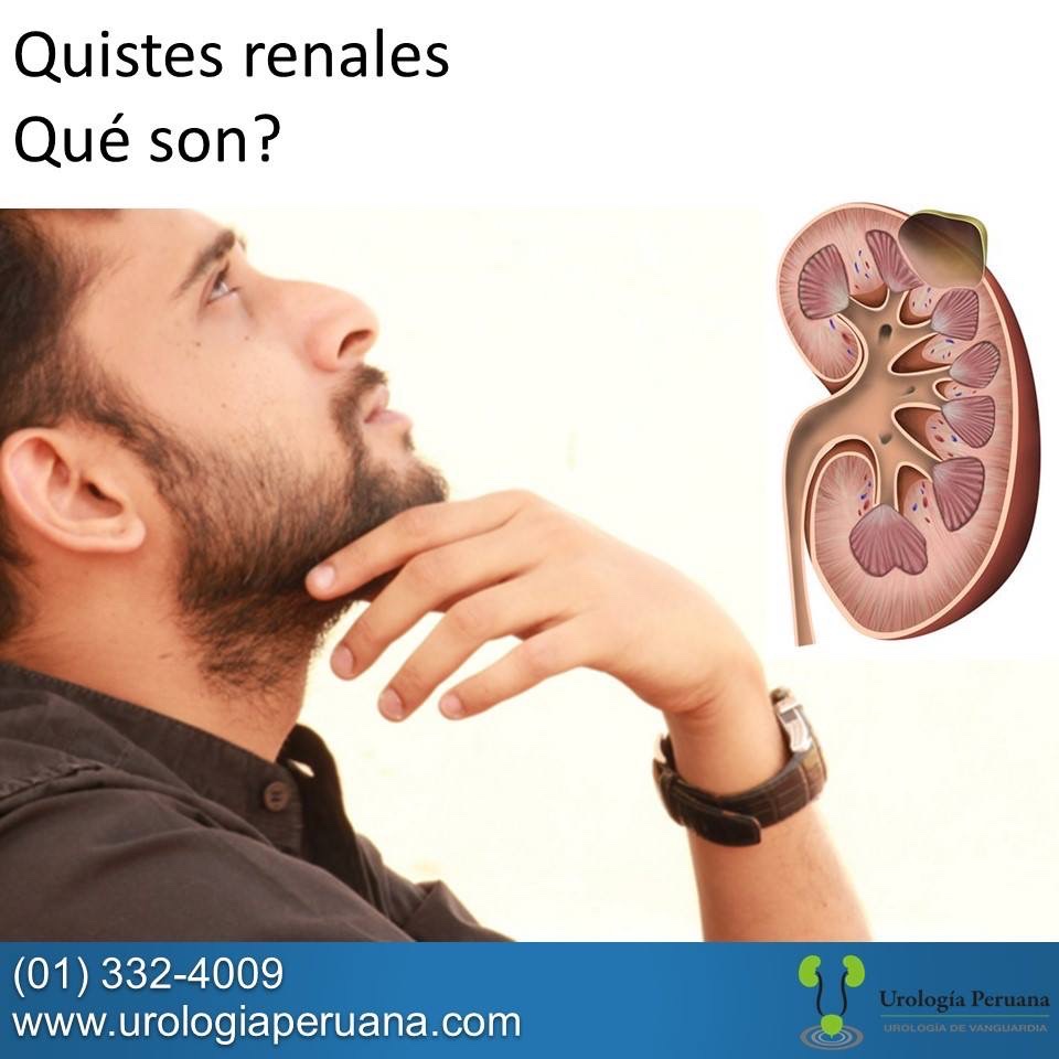 Quistes en Los riñones – Urología Peruana. Dr. Susaníbar