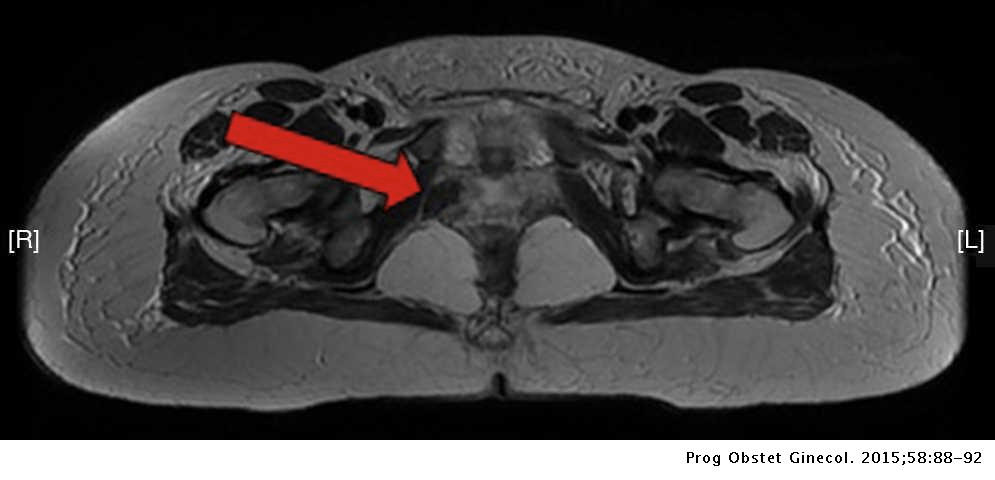 Dolor del nervio pudendo – Urología Peruana. Dr. Susaníbar