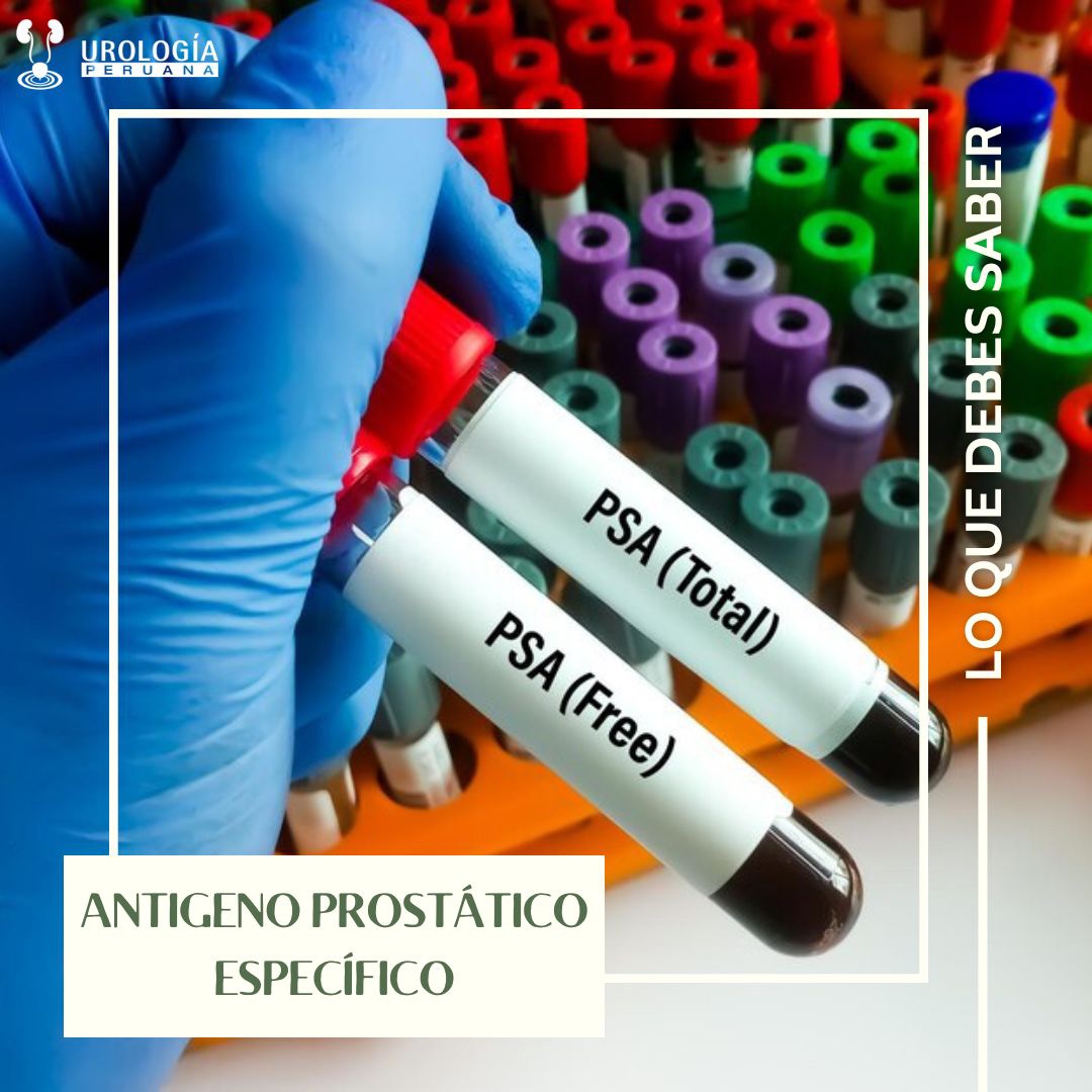 ¿Qué debemos saber antes de hacer una prueba de antígeno prostático ...