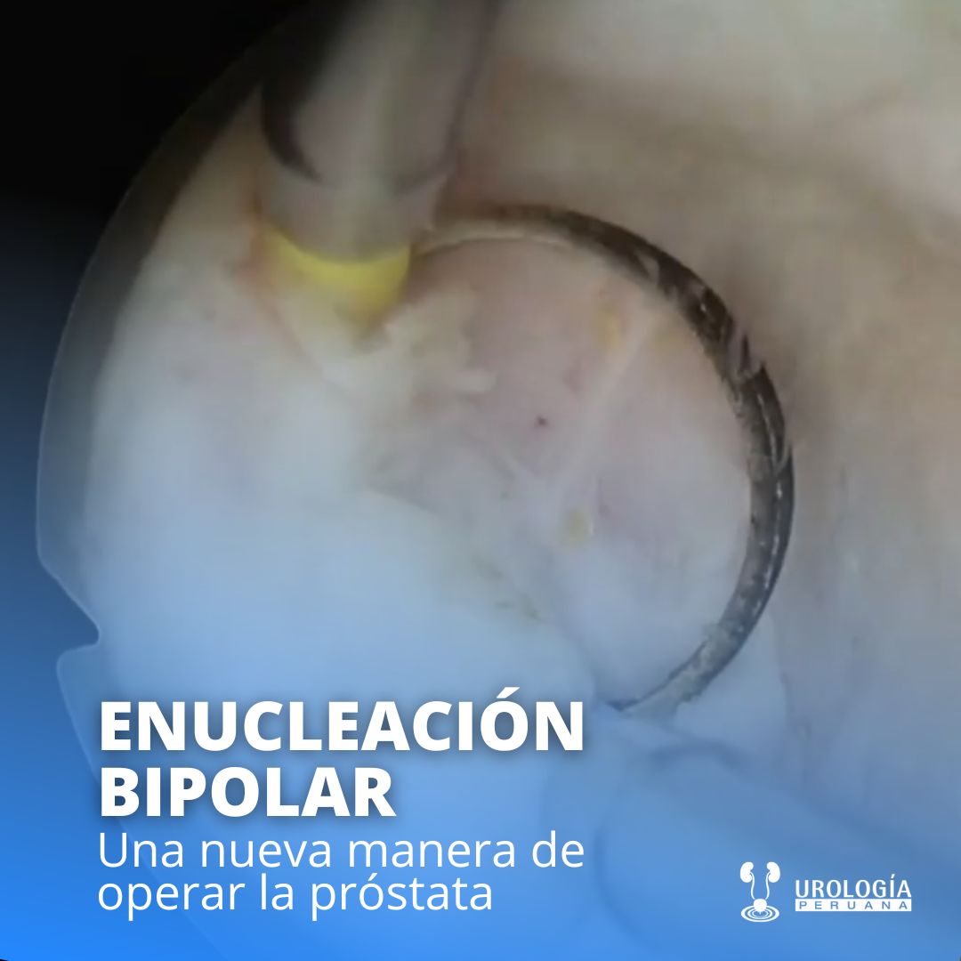 Enucleación bipolar de la prostata, un nuevo método que dará que hablar ...