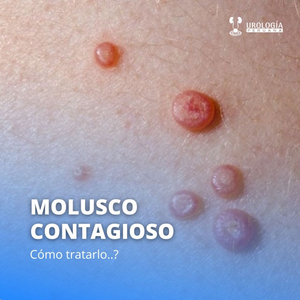 Tratamiento del molusco contagioso – Urología Peruana. Dr. Susaníbar