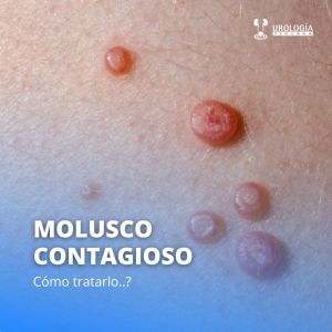 Tratamiento del molusco contagioso – Urología Peruana. Dr. Susaníbar