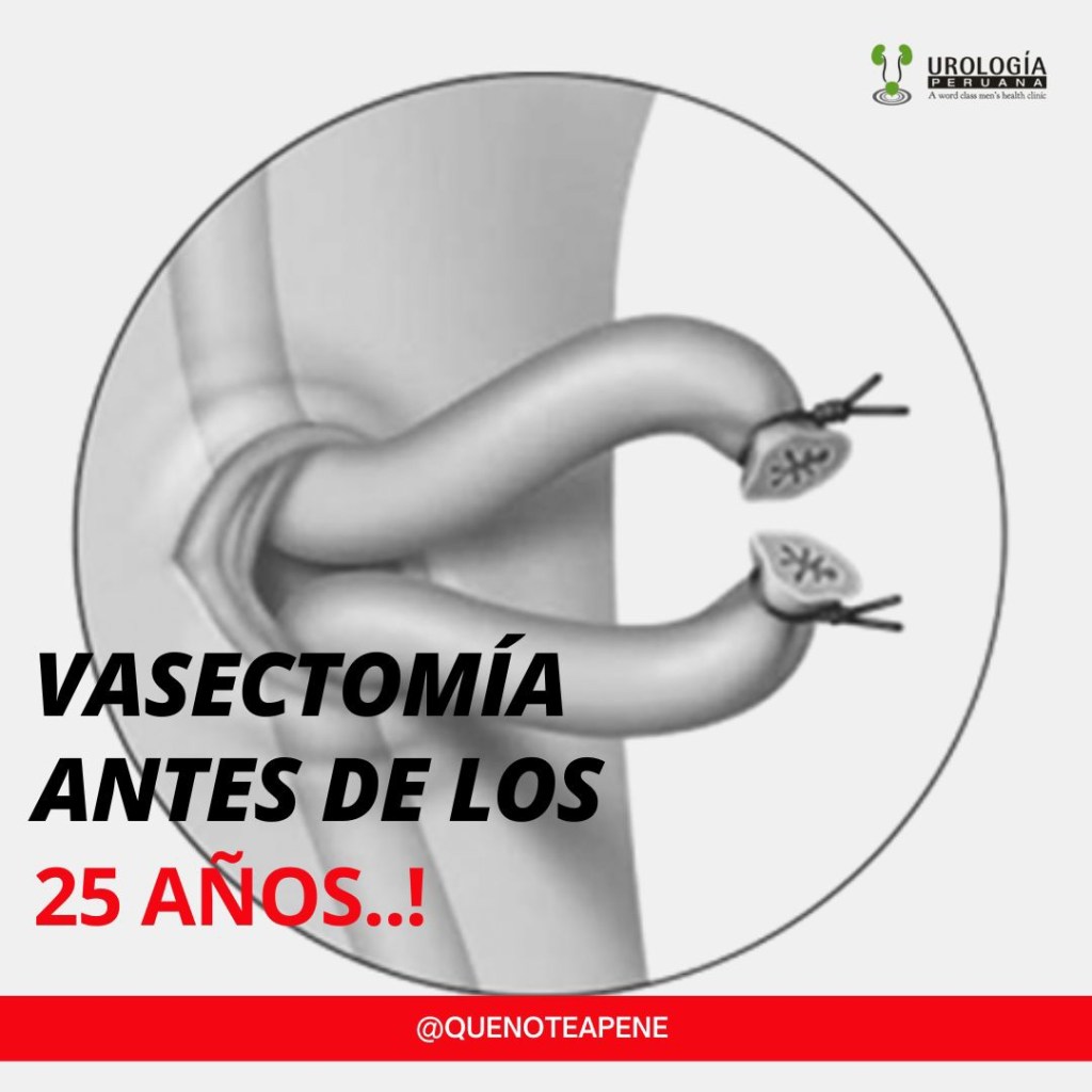 ¿Puedes hacerte una vasectomía desde los 18 años? – Urología Peruana ...