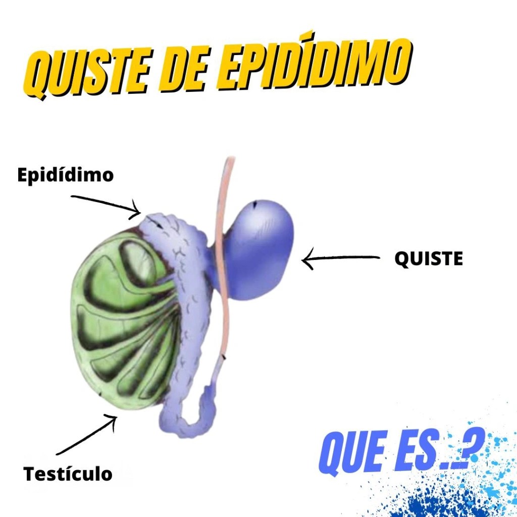 Quiste de epidídimo – Urología Peruana. Dr. Susaníbar
