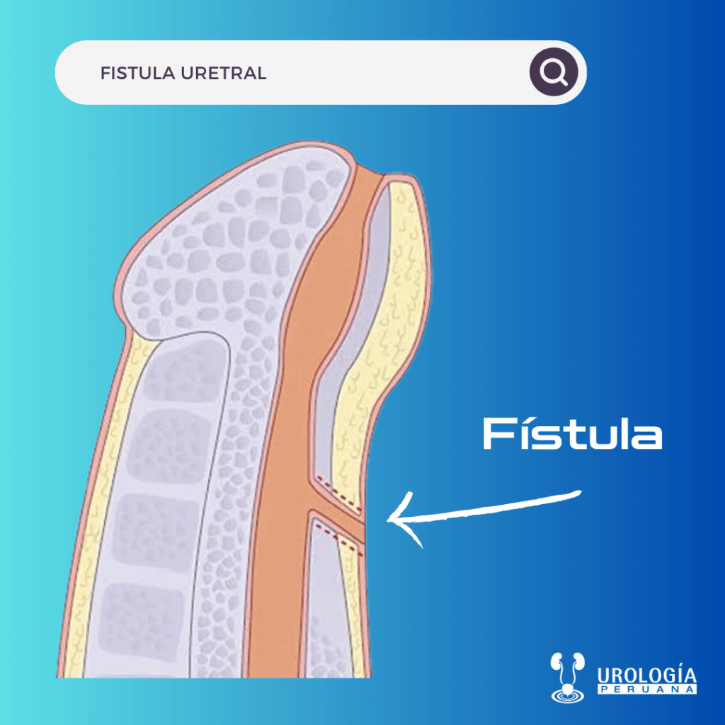 Qué es una fístula uretral – Urología Peruana. Dr. Susaníbar