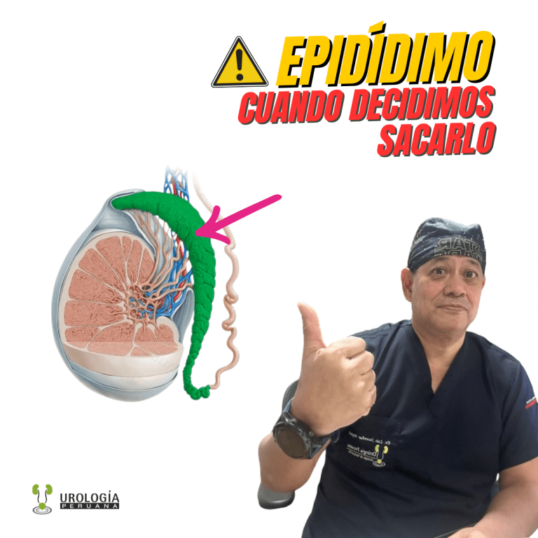 Cuándo se decide extirpar el epidídimo – Urología Peruana. Dr. Susaníbar