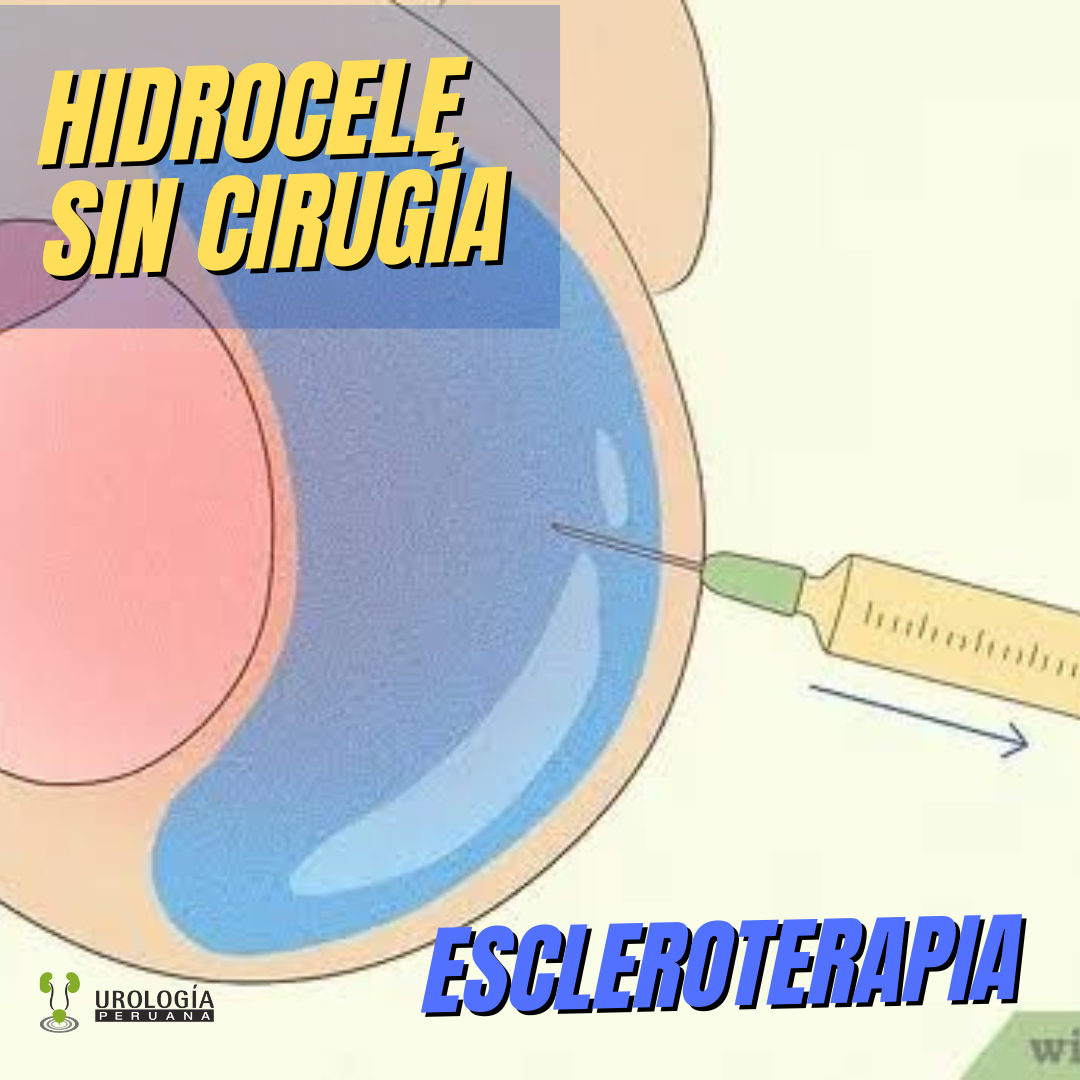 HIDROCELE sin cirugía, la escleroterapia – Urología Peruana. Dr. Susaníbar