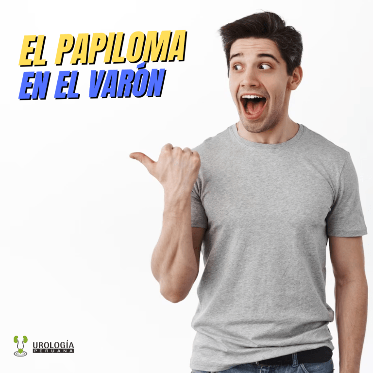 Papiloma, todo lo que debes saber. – Urología Peruana. Dr. Susaníbar
