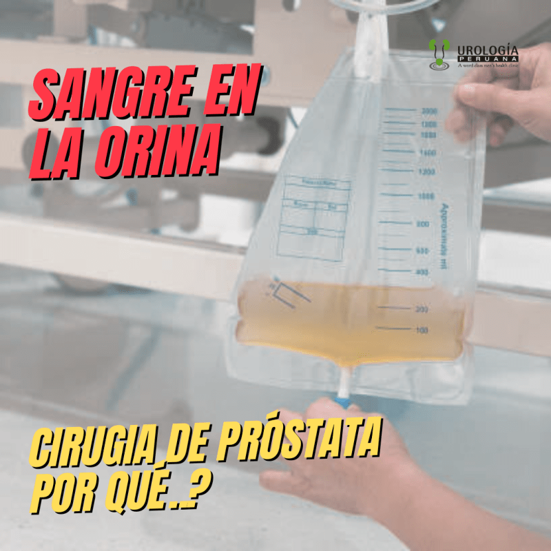 Cistitis quística – Urología Peruana. Dr. Susaníbar
