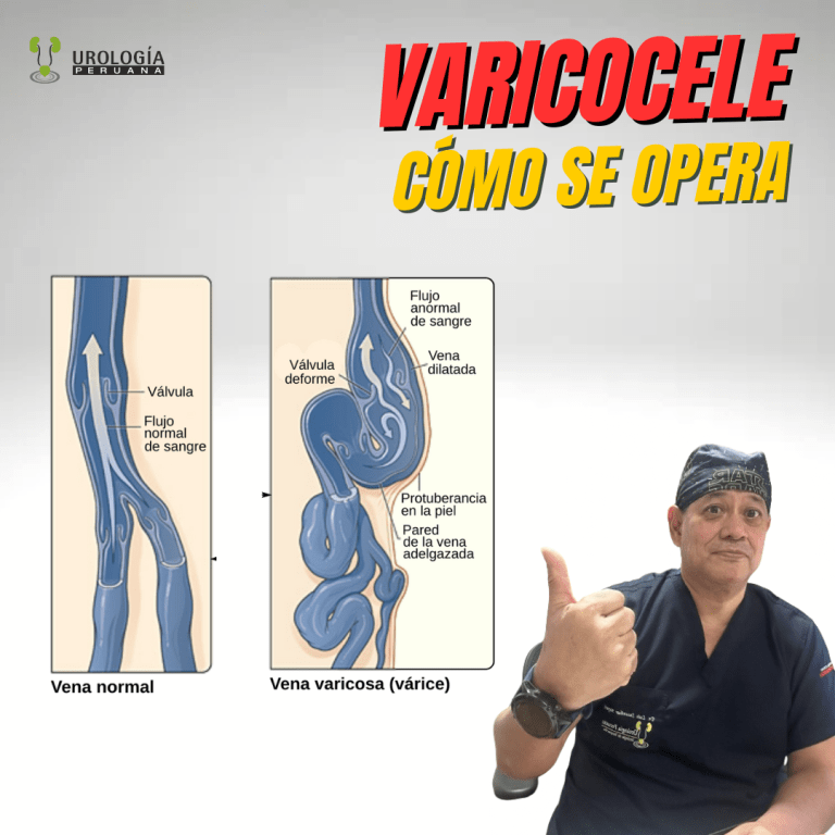 ¿Cómo se opera el varicocele? – Urología Peruana. Dr. Susaníbar