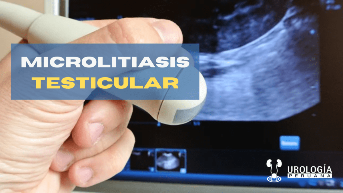 Microlitiasis Testicular: ¿Qué es y qué debo hacer si me la detectan ...