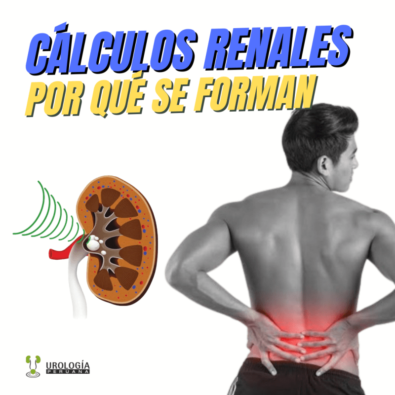 La trigonitis en la mujer – Urología Peruana. Dr. Susaníbar