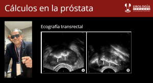 Calcificaciones prostáticas: causas, diagnóstico y tratamiento ...