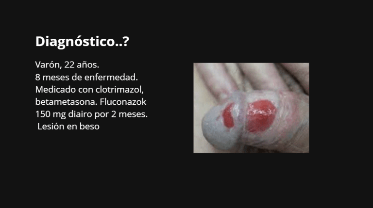 🔴 ¿BALANITIS? ESTAS IMÁGENES PUEDEN ACLARAR TUS DUDAS – Urología ...