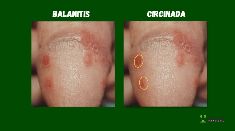 🔴 ¿BALANITIS? ESTAS IMÁGENES PUEDEN ACLARAR TUS DUDAS – Urología ...